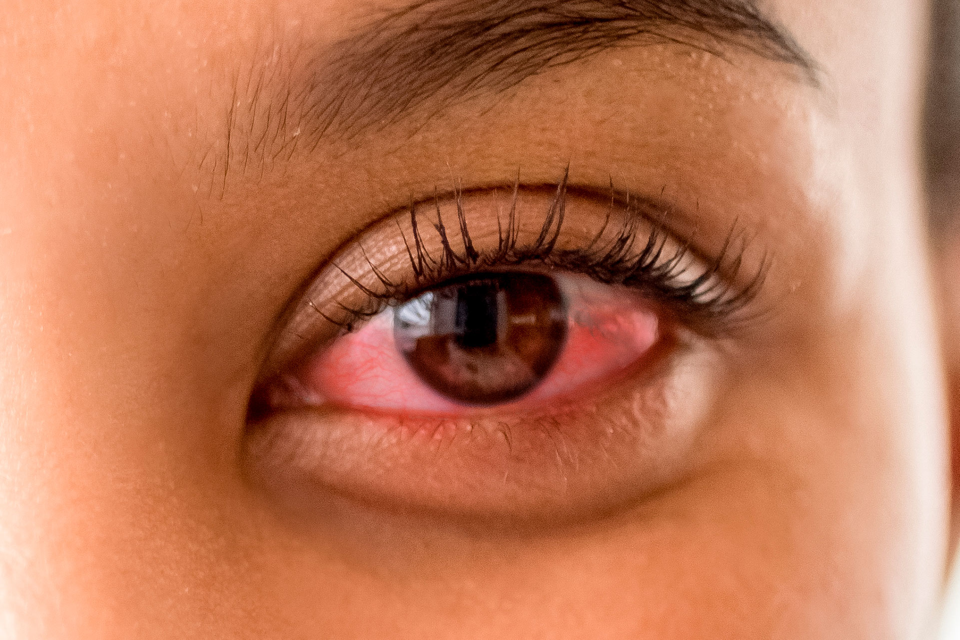 Olho Com Conjuntivite Fotos - FDPLEARN