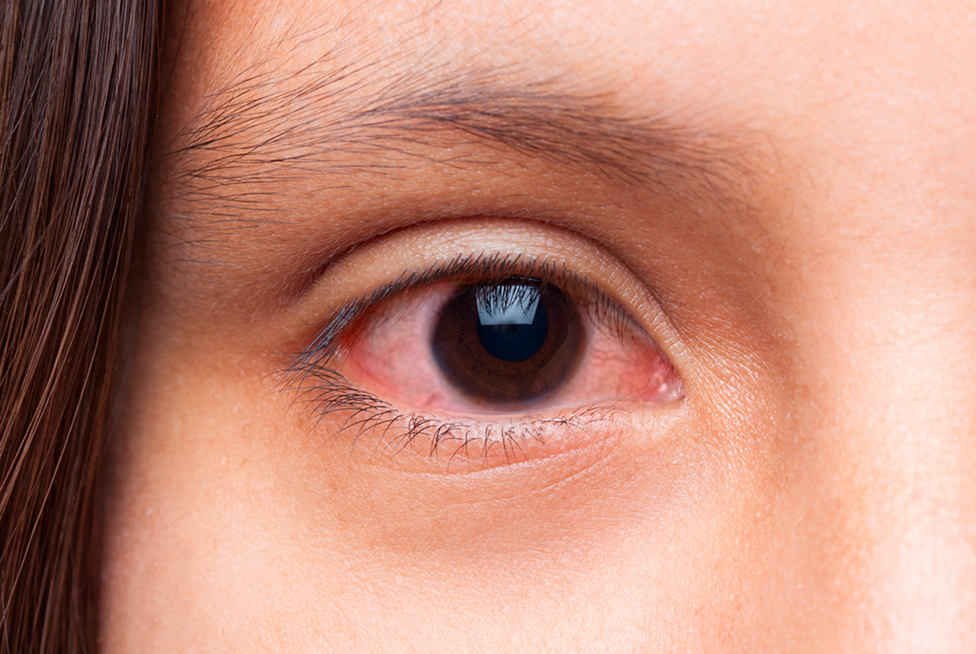 Uveíte - Clínica do Olhar